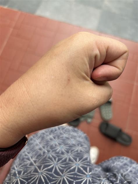 Info Bat Bites R Rabies