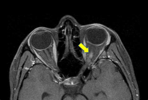 Neuritis Cervical Neuritis