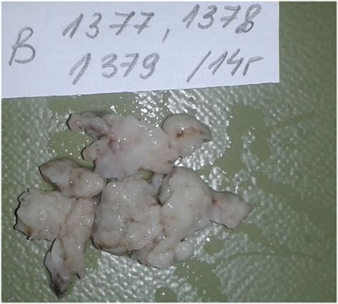 Cardiac Myosarcoma In A Newborn Infant—a Case Report And Literature