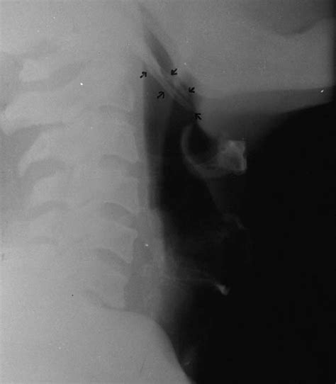 Elongated Styloid Process Eagles Syndrome A Clinical Study