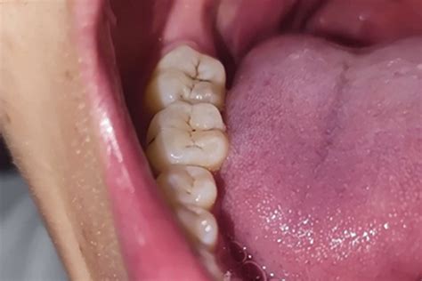 浅龋牙齿黑斑图片