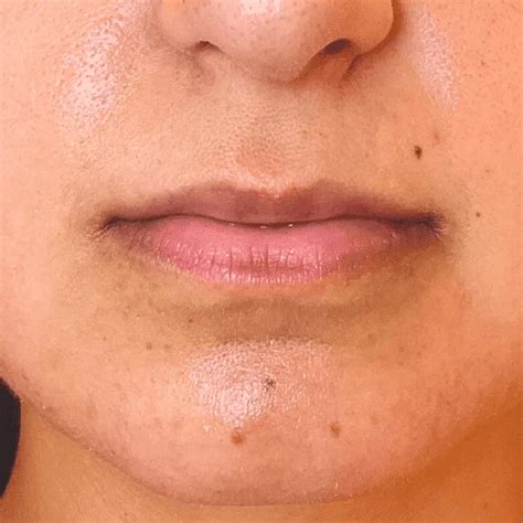 Varicose Veins My Blog