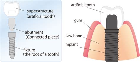 Hypodontia Replacing Congenitally Missing Teeth With Implants