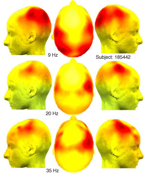 The Hyperactive Resting Brain On Meg