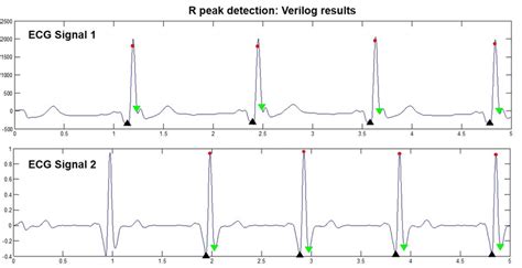 Qrs Complex Detection Download Scientific Diagram
