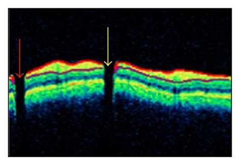 blink artifacts in a cirrus hd oct right optic disc scan two blinks