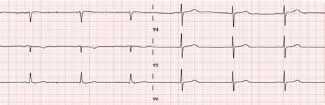 Acls Algorithms