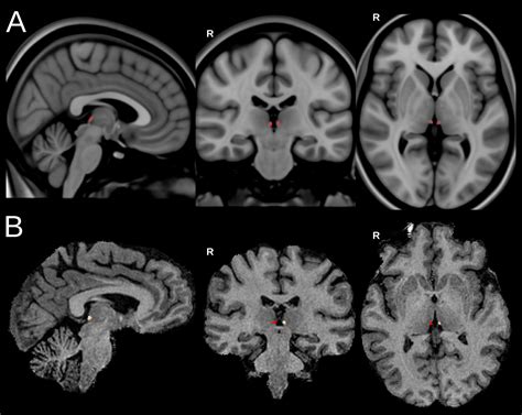 Habenular Involvement In Response To Subcallosal Cingulate Deep Brain Stimulation For Depression