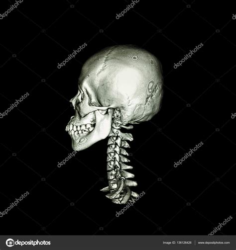 Tomografia De Cranio Normal Retoedu