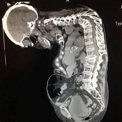 An Extreme Case Of Gibbus Deformity Medizzy Journal