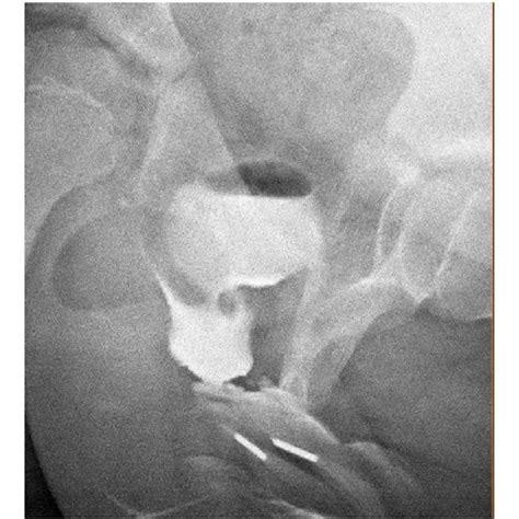 Micturating Cystourethrography In The 10 Year Old Girl Showing