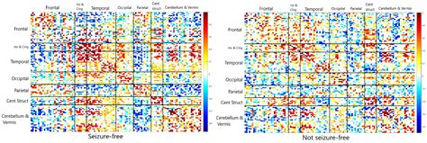 Metabolic Connectivity Can Help Predict Seizure Outcomes In Temporal Lobe Epilepsy Surgery