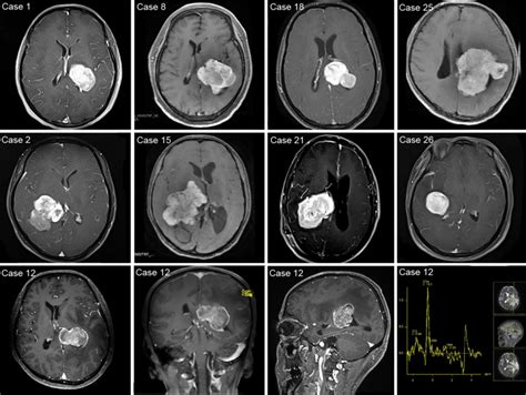 Mri And Mrs Characteristics Of The High Grade Lateral Ventricular