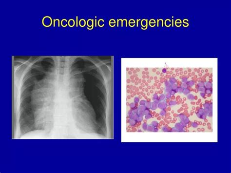 Ppt Oncologic Emergencies Powerpoint Presentation Free Download Id 4521882