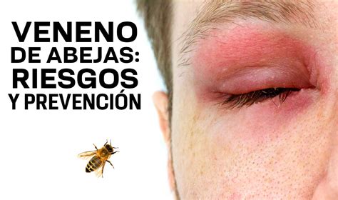 Picaduras De Abejas En Personas Alergicas