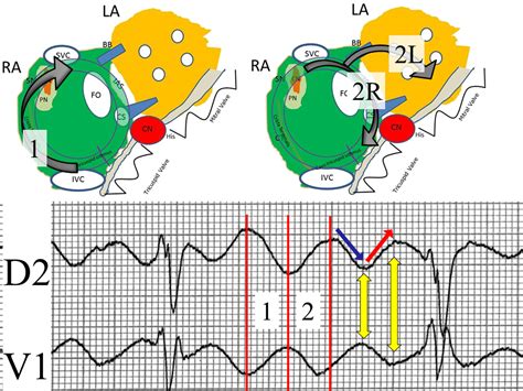 Electrocardiographic Approach To Atrial Flutter Cardiac Electrophysiology Clinics