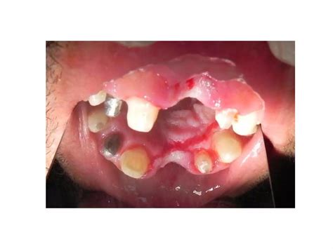 Soft Tissue Augmentation Ppt