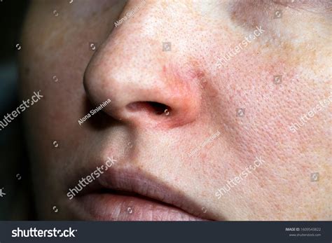 18 Imágenes De Cuperosis Imágenes Fotos Y Vectores De Stock