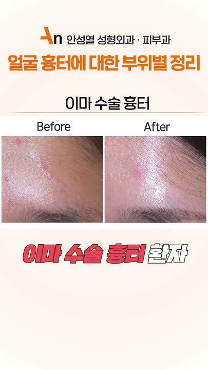 얼굴에 긁힌 흉터 수술 자국이나 여드름 자국 치료 사례 영상 공개 Youtube