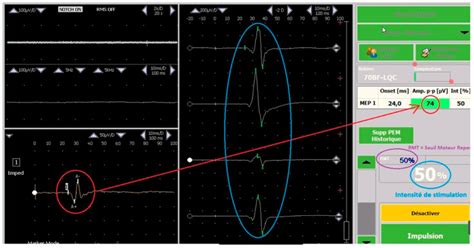 Variability In Motor Threshold During Transcranial Magnetic Stimulation Treatment For Depression
