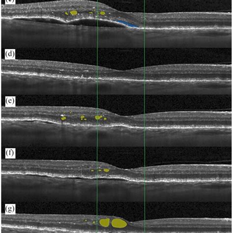 Example Of Real Time Quantification Of Macular Fluid Volumes Srf