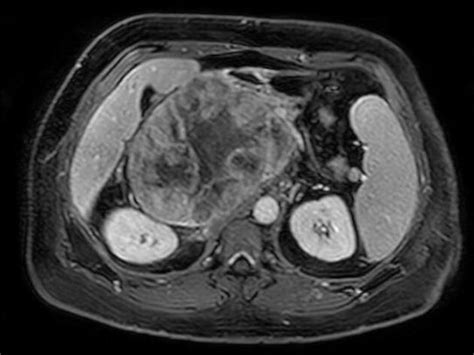 Retroperitoneal Malignant Fibrous Histiocytoma Pacs