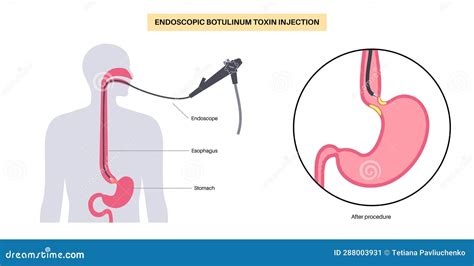 esophageal botulinum toxin injection vector illustration