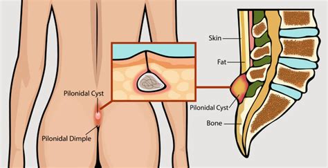 Pilonidal Disease Treatment