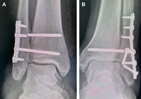 Acute Syndesmosis Injuries Clinics In Podiatric Medicine And Surgery