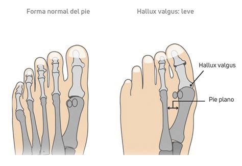Nuevo Corrector De Juanetes Hallux Valgus Actytoe