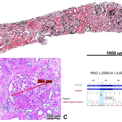 Oligomeganephronia And Adaptive Focal Segmental Glomerulosclerosis Download Scientific Diagram