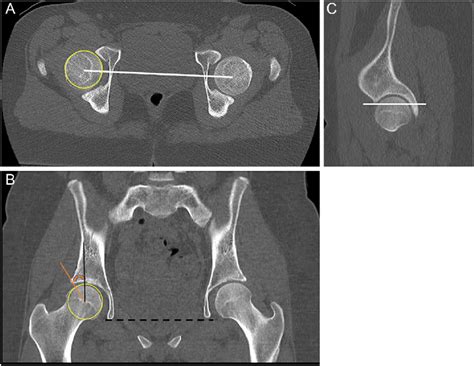 Definition Of Hip Center And Horizontal Axis The Center Of The Femoral