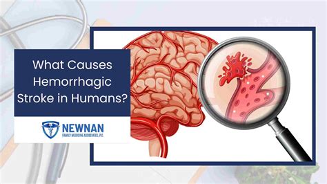 What Causes Hemorrhagic Stroke In Humans