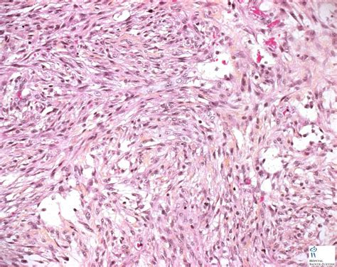 Nodular Fasciitis Human Pathology Photos Pictures Videos