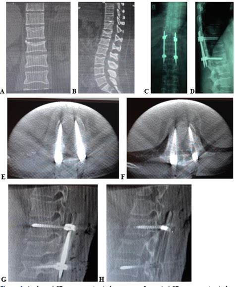 Figure 1 From Using An Intraoperative Computed Tomography Scanner With