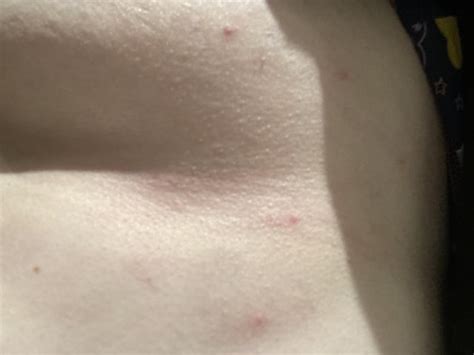 Newly Diagnosed Rfolliculitis