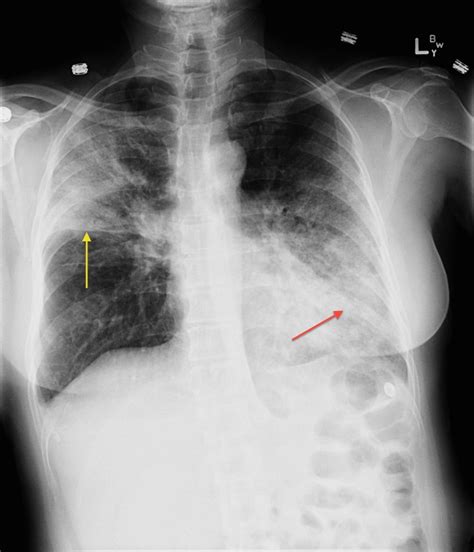 Right Upper Lobe And Lingular Consolidation Radiology At St Vincents University Hospital