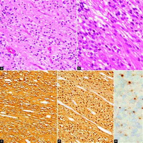 Hematoxylin And Eosin Staining 200 × A And 400 × B Showed Spindled Download Scientific