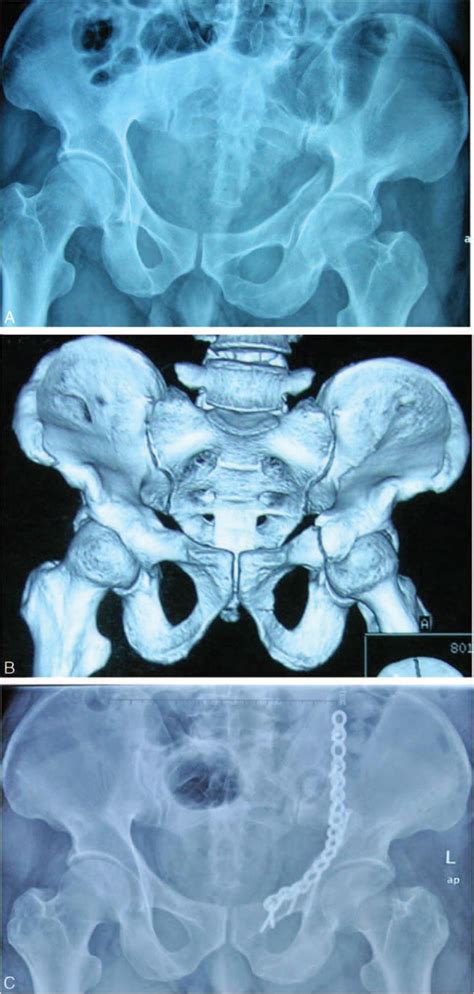 A 51 Year Old Man Suffered From Acetabular Fracture A The Download Scientific Diagram