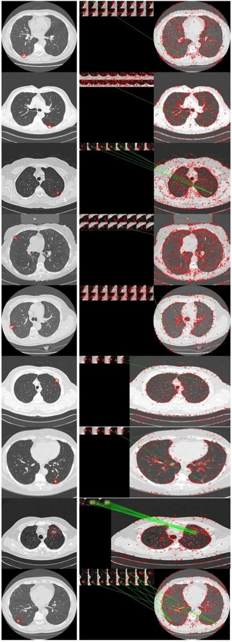 The Detected And Matched Nodule Features Obtained Using Sift Flann
