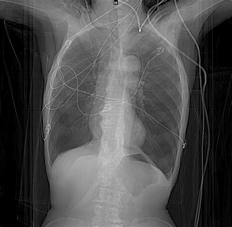Faces Of Emphysema Panlobular Lungs