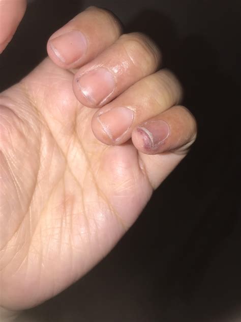 Skin Around Nails Became Itchy Painful And Now The Small Watery Humps