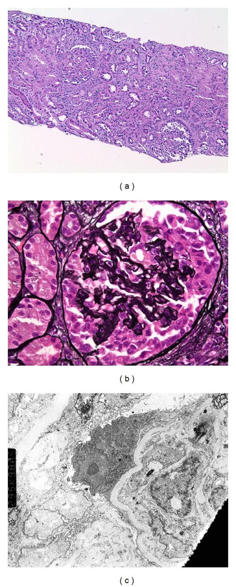 A Collapsed Glomerular Capillary Loops With Obliteration Of Vascular Download Scientific