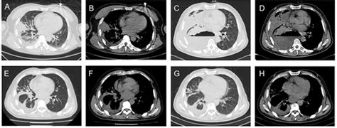 Full Article Fusobacterium Nucleatum Induced Pyopneumothorax A Rare But Serious Clinical Entity