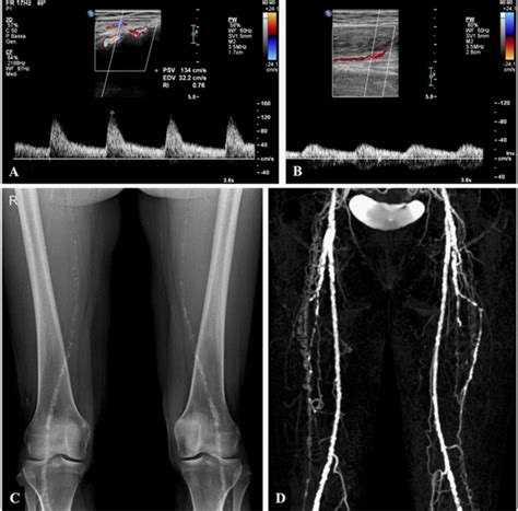 Challenging Arterial Calcification Disease Associated With Rare Nt5e Gene Mutation Bmj Case