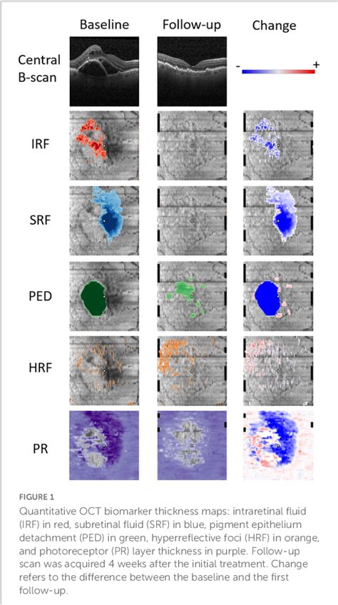 Figure 1 From Predicting Treat And Extend Outcomes And Treatment Intervals In Neovascular Age