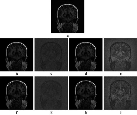 Denoising Results Obtained On Very Noisy Images Acquired Using A Sense