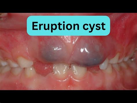 Eruption Cyst