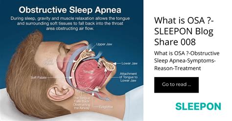 What Is Osa Obstructive Sleep Apnea Symptoms Reason Treatment