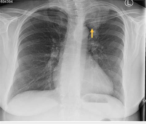 What Is Apex In Lung At Mary Nugent Blog